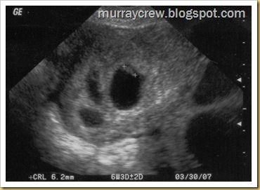 Triplet Pregnancy Ultrasound Pregnancy Photo Frame Three Trimesters